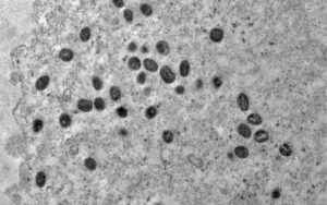 Mpox: São Paulo confirma segundo caso da doença pela nova cepa clado Ib ...